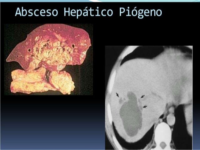 Absceso hepatico