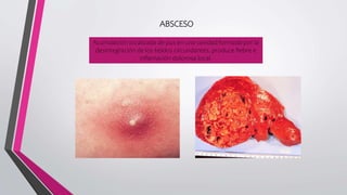 Absceso hepático | PPTX