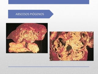 Absceso hepático | PPTX