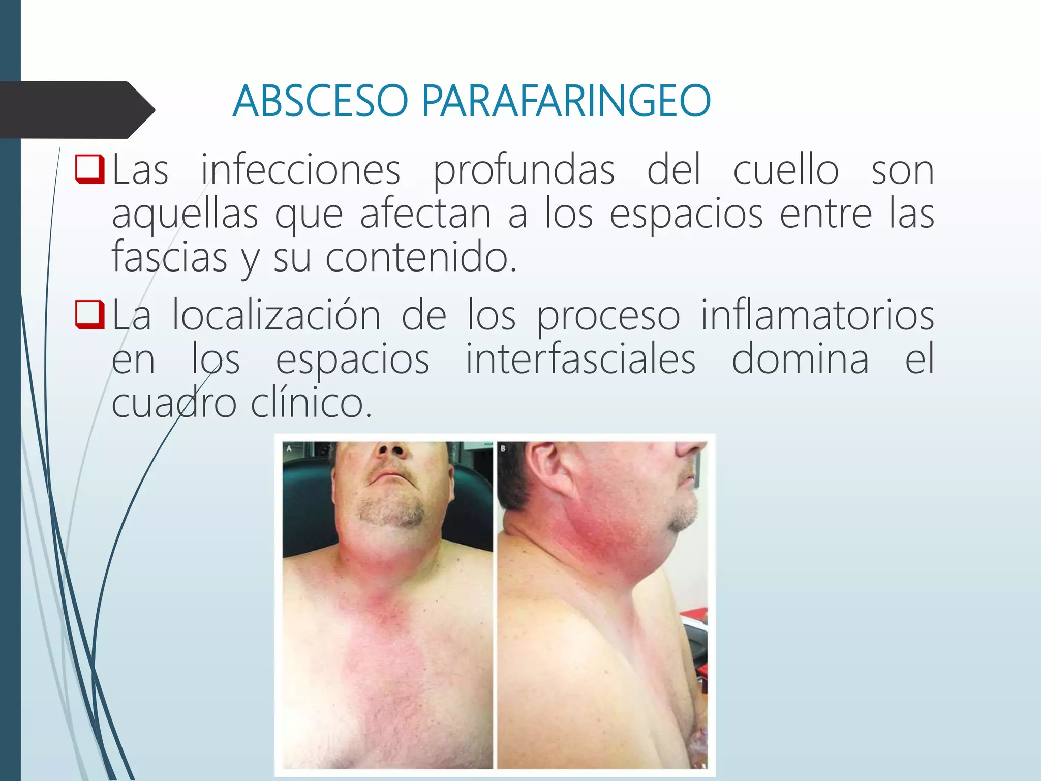 Absceso parafaringeo, OTORRINOLARINGOLOGIA | PPTX