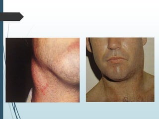 Absceso parafaringeo, OTORRINOLARINGOLOGIA | PPTX