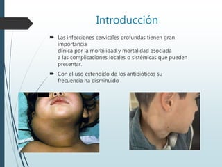 Absceso parafaringeo, OTORRINOLARINGOLOGIA | PPTX