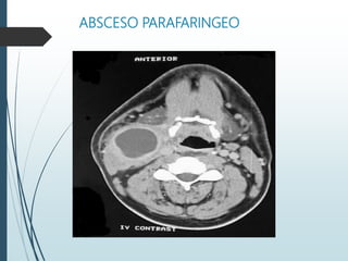 Absceso parafaringeo, OTORRINOLARINGOLOGIA | PPTX