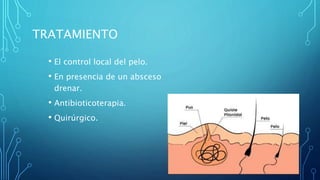 Absceso perianal y quiste.pptx
