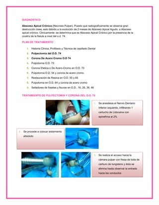 Absceso periapical op | DOCX