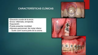 Absceso periodontal y amigdalino en urgencias | PPTX