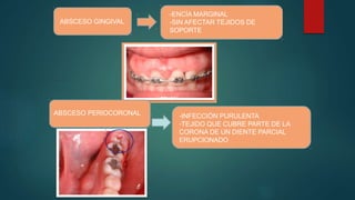 Absceso periodontal y amigdalino en urgencias | PPTX