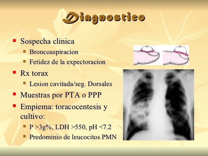 Absceso pulmonar