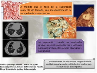 ABSCESO PULMONAR NEUMONOLOGIAAAAAAA.pptx