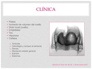 Absceso retrofaringeo | PPTX