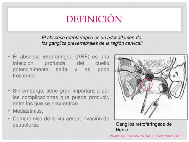 Absceso retrofaringeo