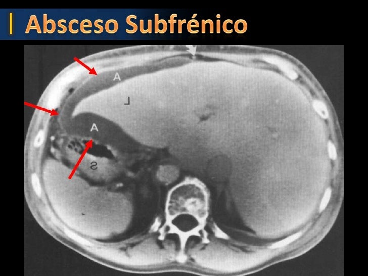 Abscesos Intrabdominales