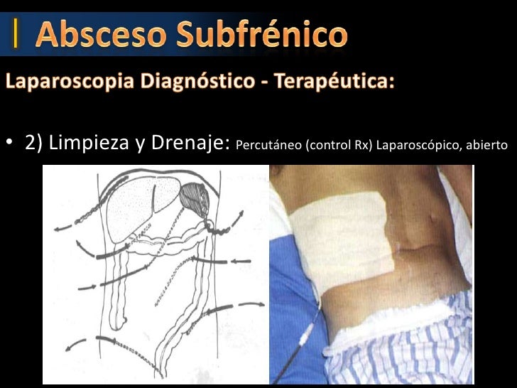 Abscesos Intrabdominales