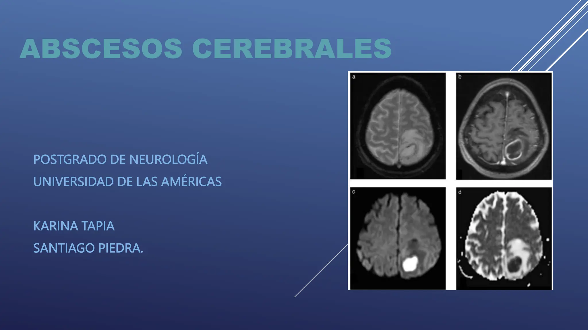Abscesos cerebrales.pptx