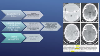 Abscesos cerebrales.pptx