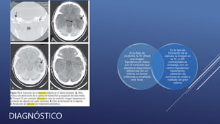Abscesos cerebrales.pptx