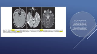 Abscesos cerebrales.pptx