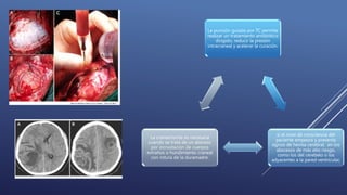 Abscesos cerebrales.pptx