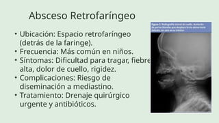 Abscesos_Cervicales_Otorrinolaringologia_16_9.pptx_20241028_072858_0000 ...