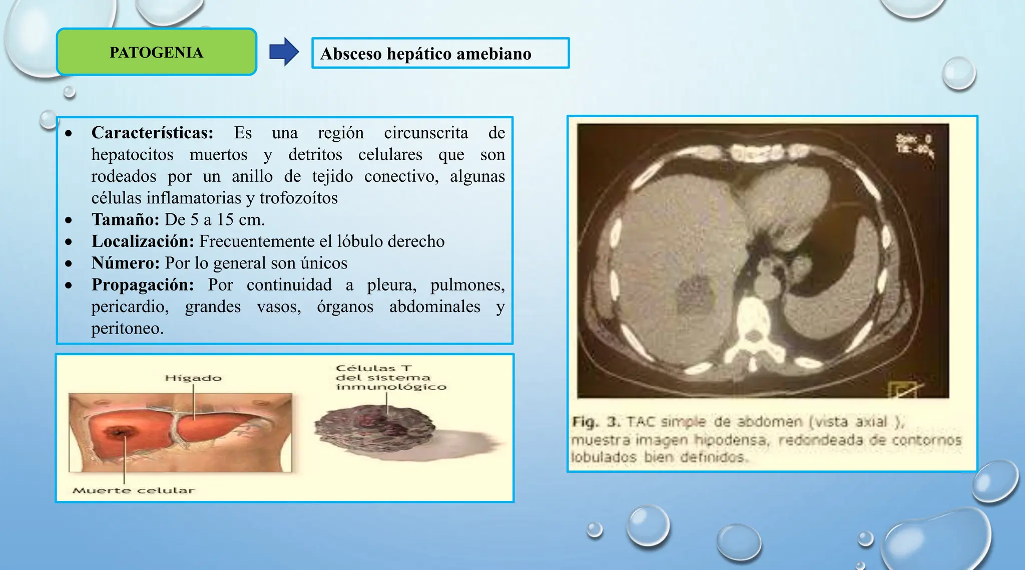 Abscesos hepáticos: Absceso amebiano y absceso piógeno | PPTX