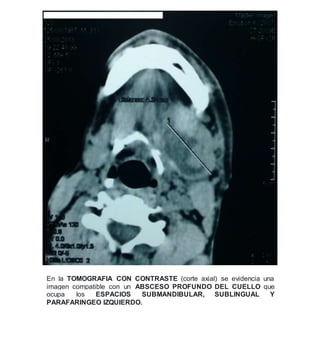 ABSCESOS PROFUNDOS DEL CUELLO | DOCX