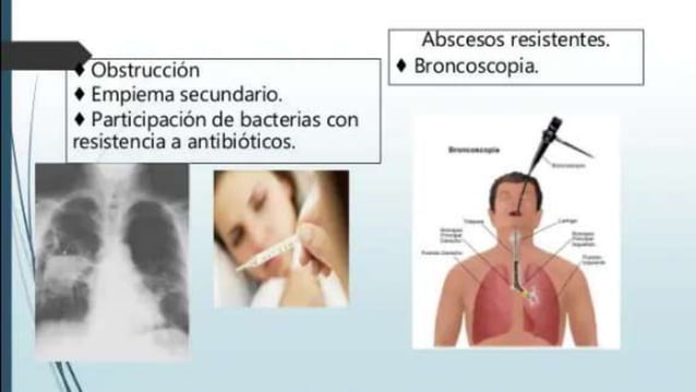ABSCESOS PULMONARES | PPTX