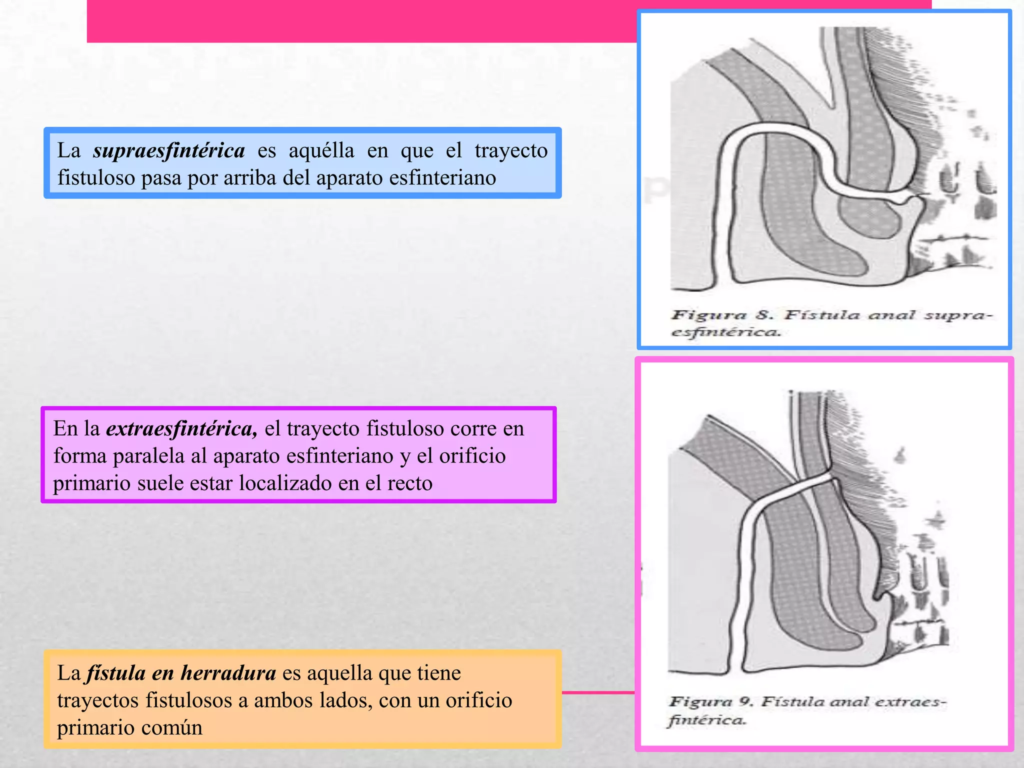 Abscesos y fistulas anorrectales | PPTX