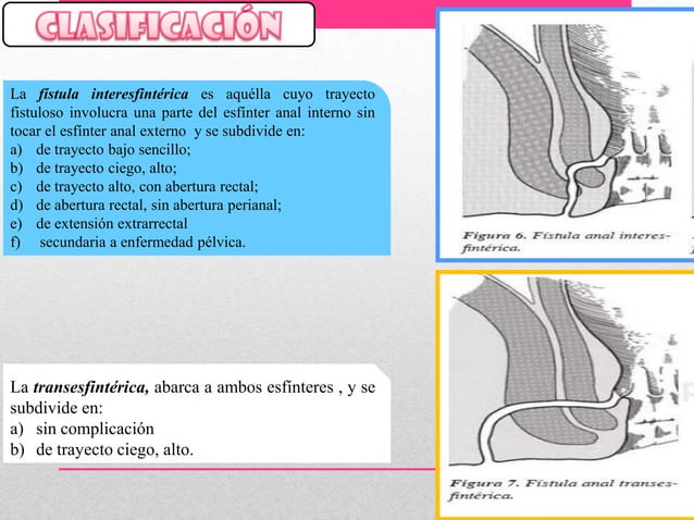 Abscesos y fistulas anorrectales | PPTX