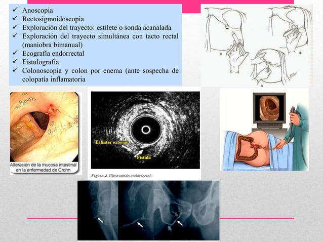 Abscesos y fistulas anorrectales | PPTX