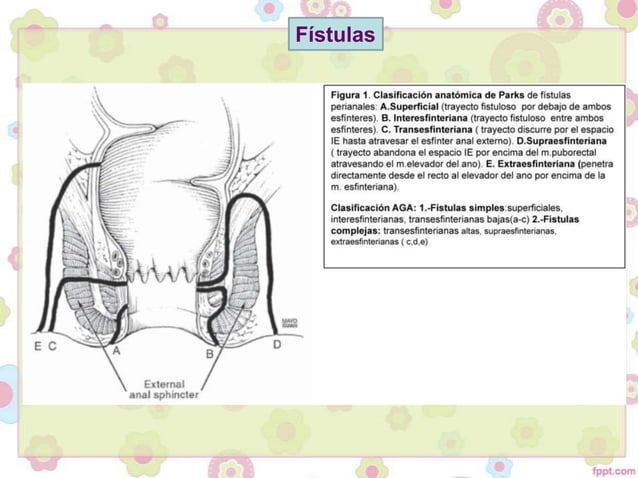 Abscesos y fistulas anorrectales | PPTX