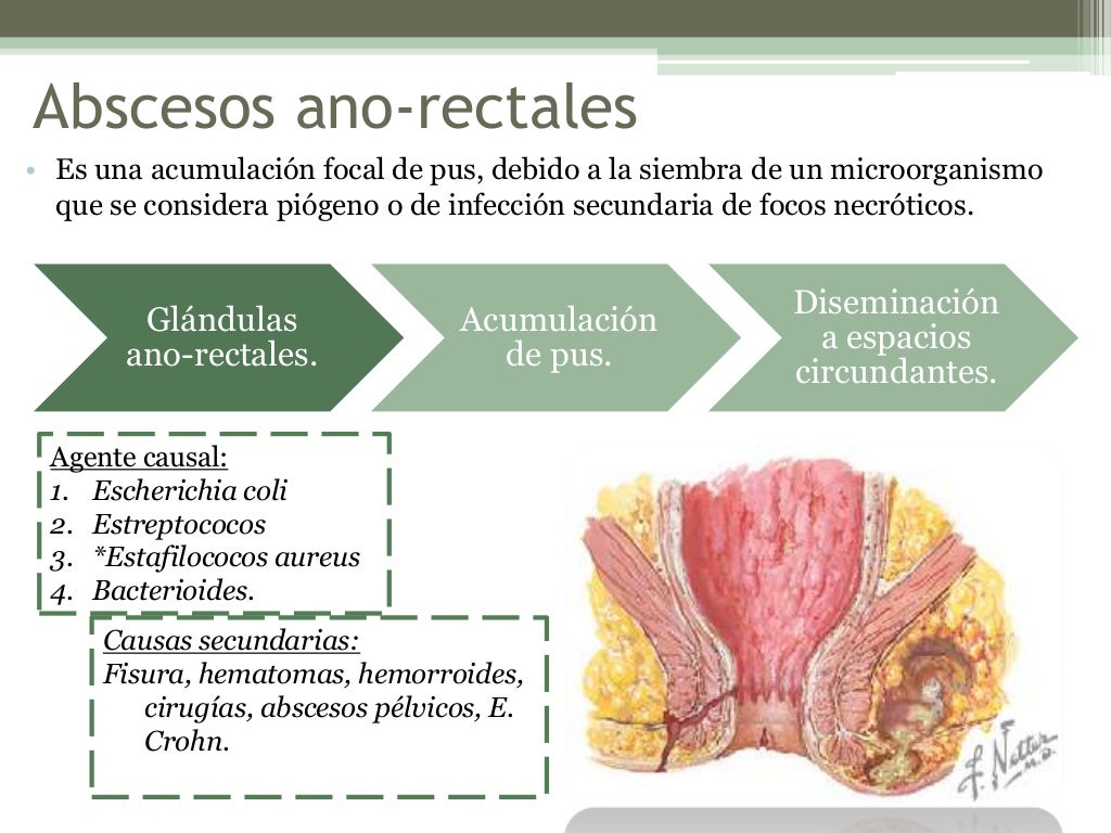 Abscesos y fístulas ano rectales