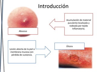 Abscesos y úlceras | PPTX