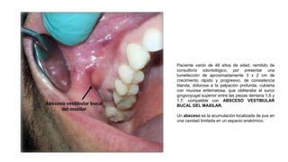 ABSCESO VESTIBULAR BUCAL DEL MAXILAR | PPTX