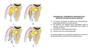 ABSCESO VESTIBULAR BUCAL DEL MAXILAR | PPTX
