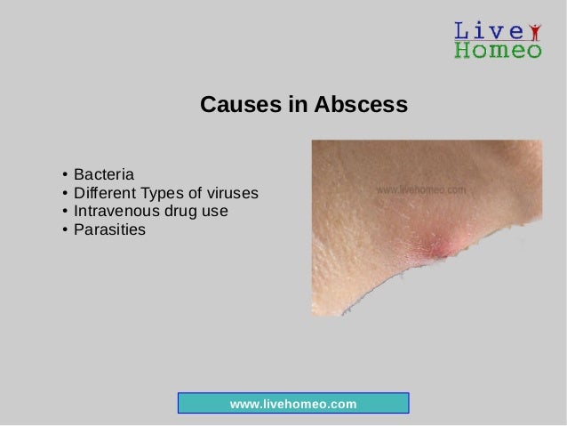 Effective ways to treat abscess problems