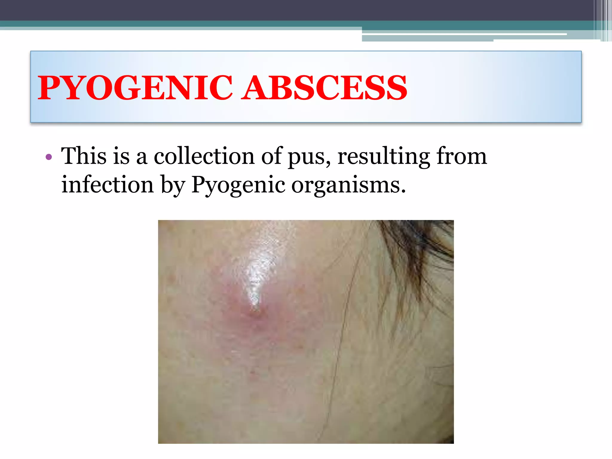 Abscess | PPTX