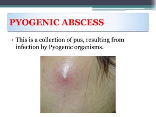 Abscess | PPTX