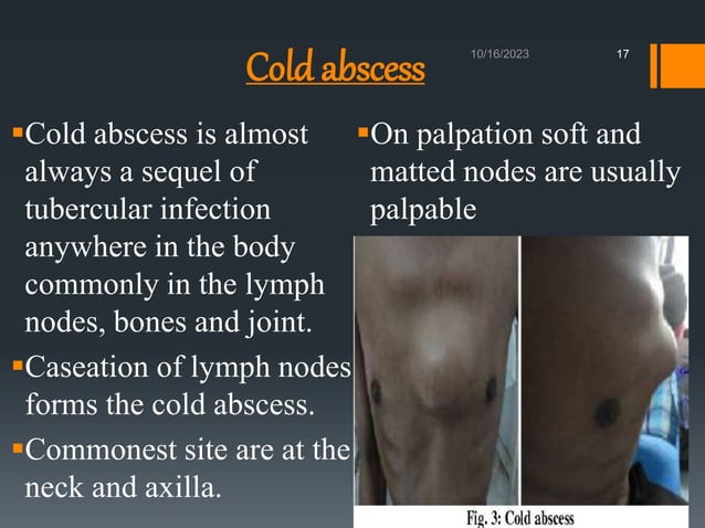 abscess.pptx
