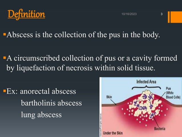 abscess.pptx