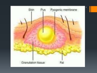 abscess.pptx | Free Download