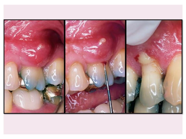 presentation abscess of the periodontium .pptx