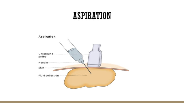 Abscess Pptx Surgery Ppt Types And Management Pptx
