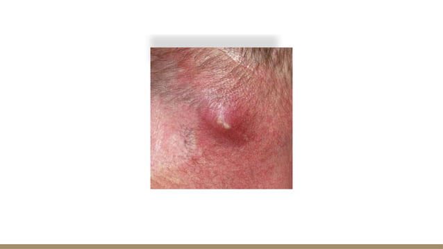 Abscess Pptx Surgery Ppt Types And Management Pptx
