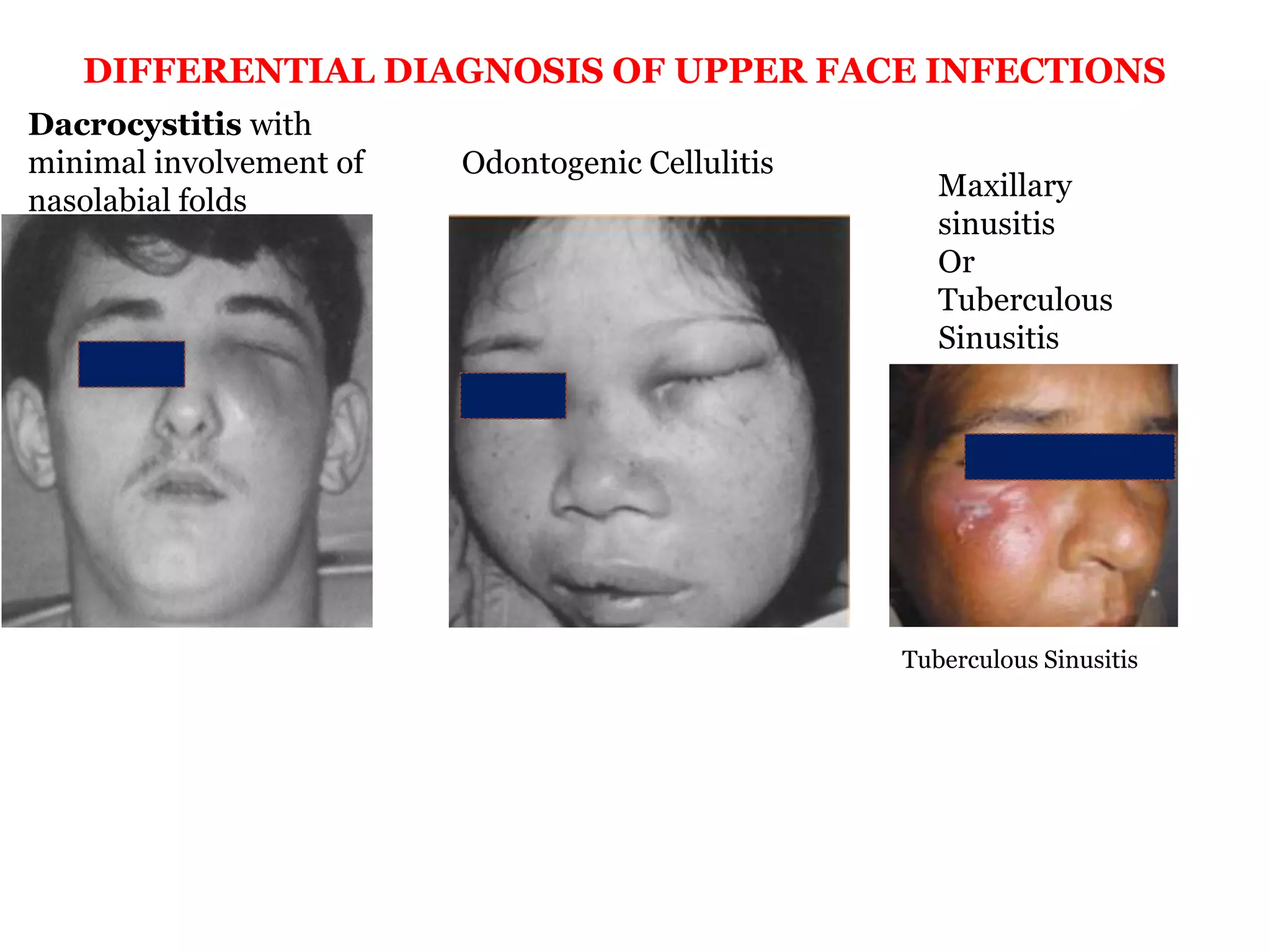 Abscess oral maxillo-presentation | PPTX