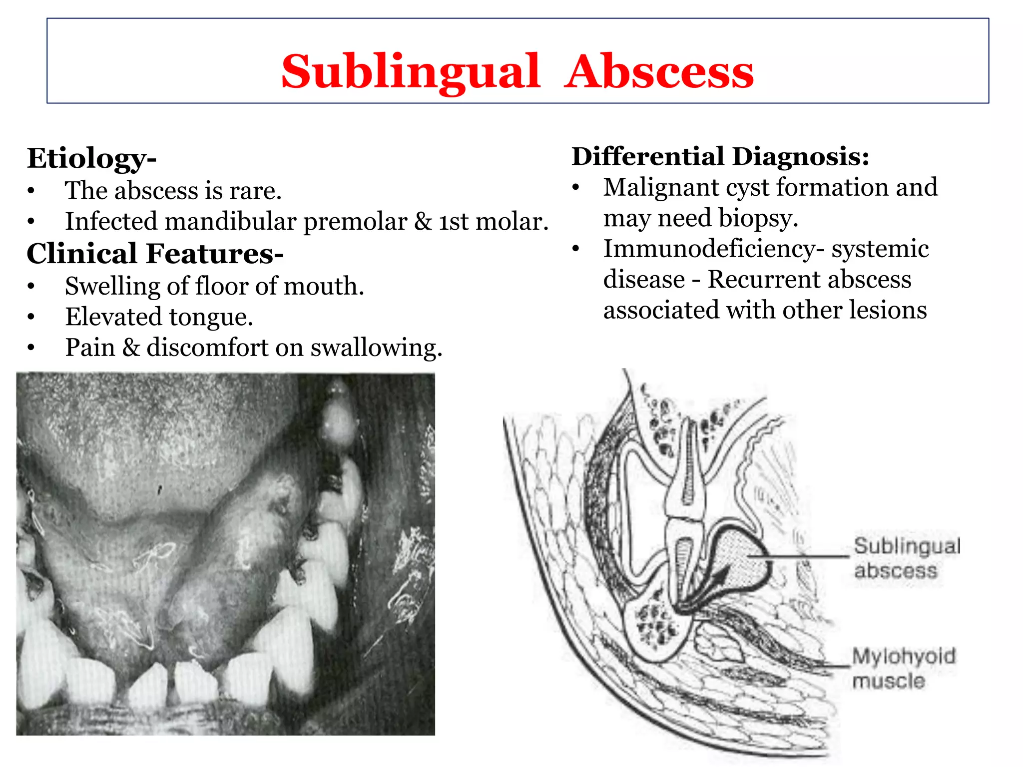 Abscess oral maxillo-presentation | PPTX