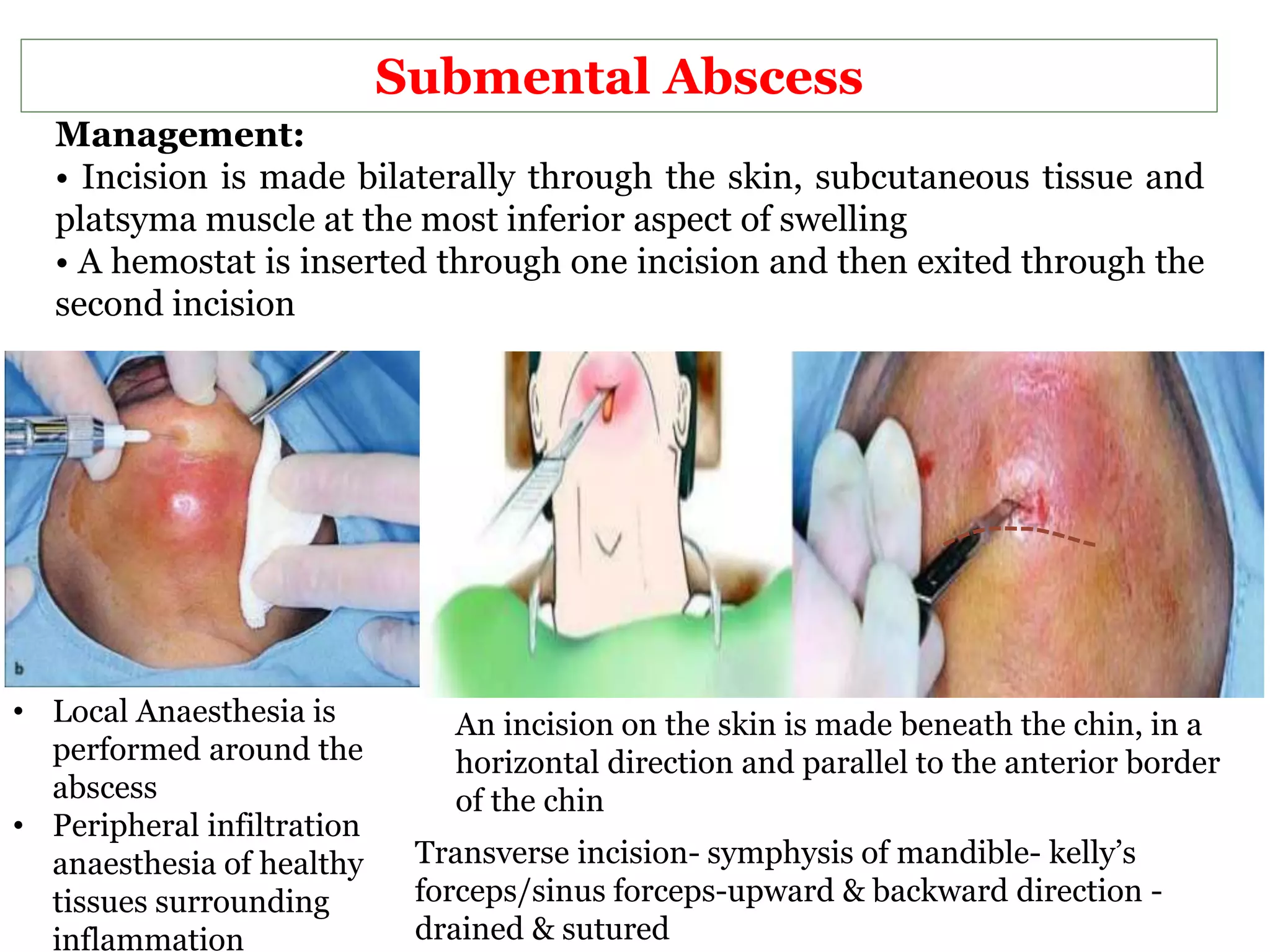 Abscess oral maxillo-presentation | PPTX