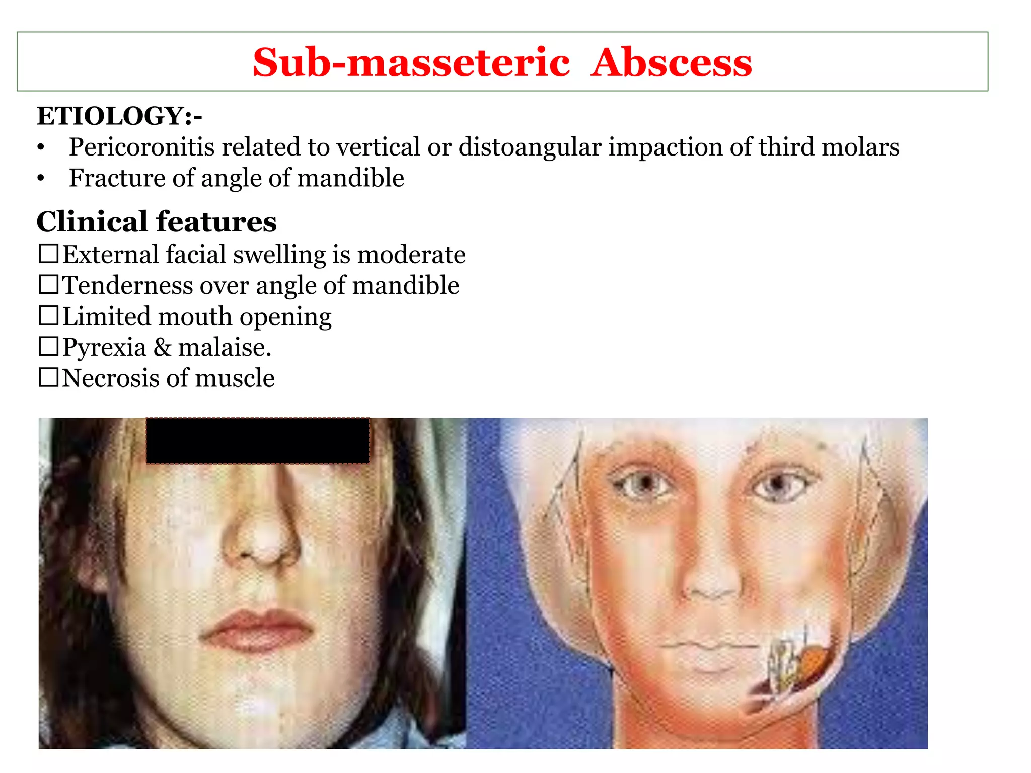 Abscess oral maxillo-presentation | PPTX