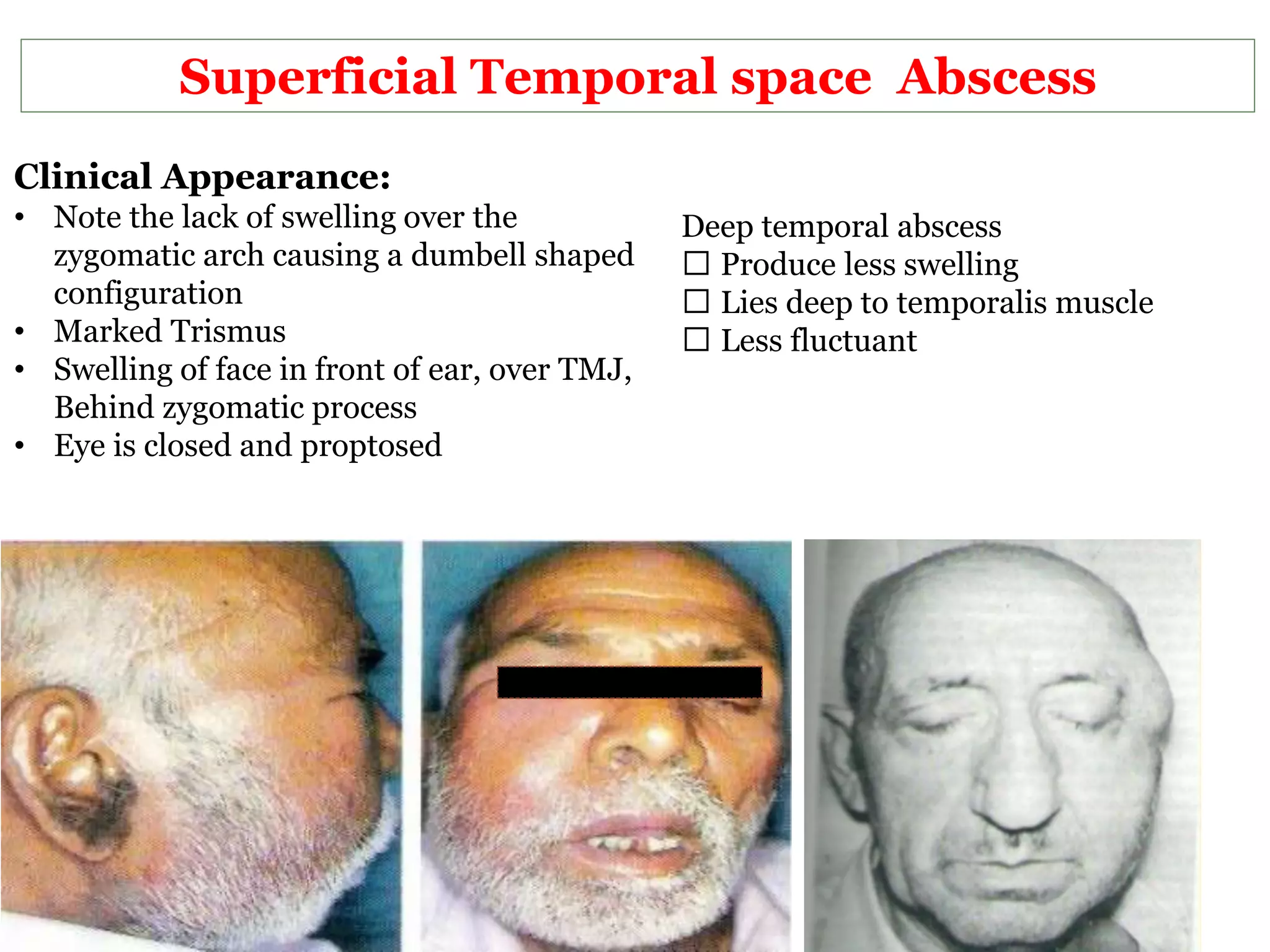 Abscess oral maxillo-presentation | PPTX