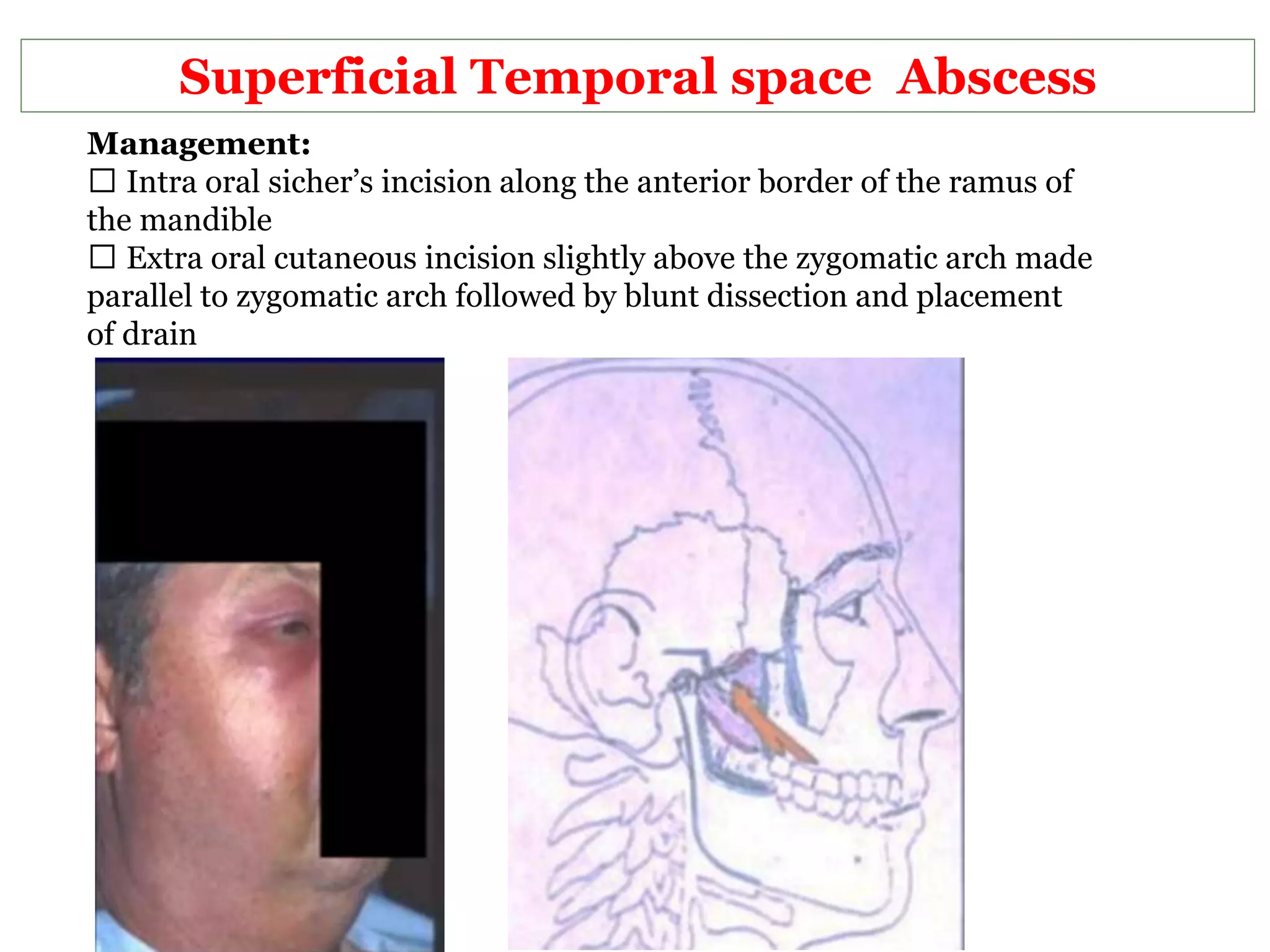 Abscess oral maxillo-presentation | PPTX
