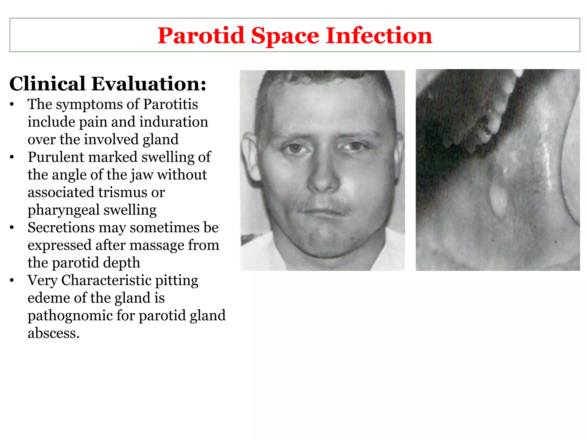 Abscess oral maxillo-presentation | PPTX